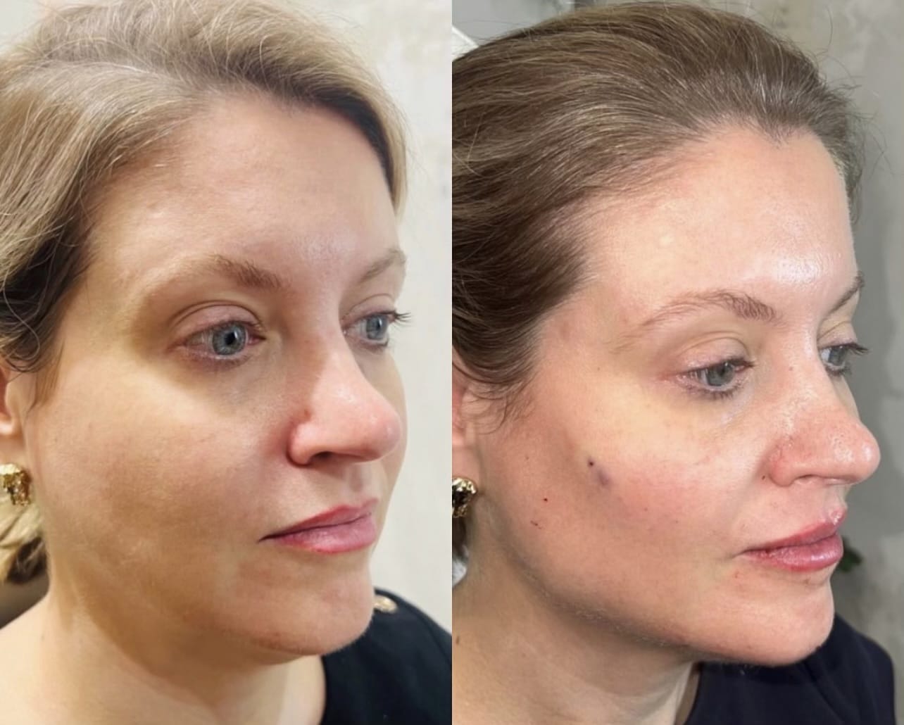 Before & After MedSpa Treatment Gallery | Stay Sculpted