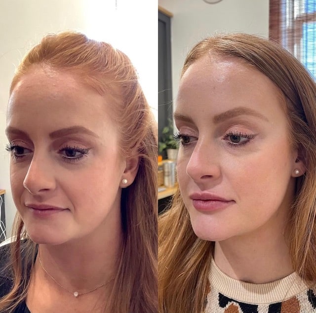 Before & After MedSpa Treatment Gallery | Stay Sculpted