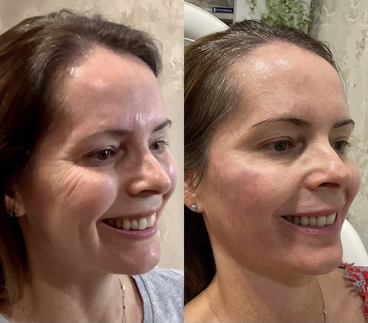 Before & After MedSpa Treatment Gallery | Stay Sculpted